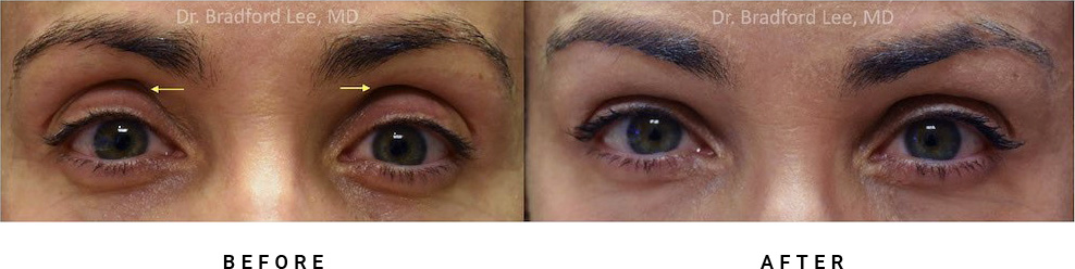 Specials | Oculofacial Plastic Surgery of Hawaii